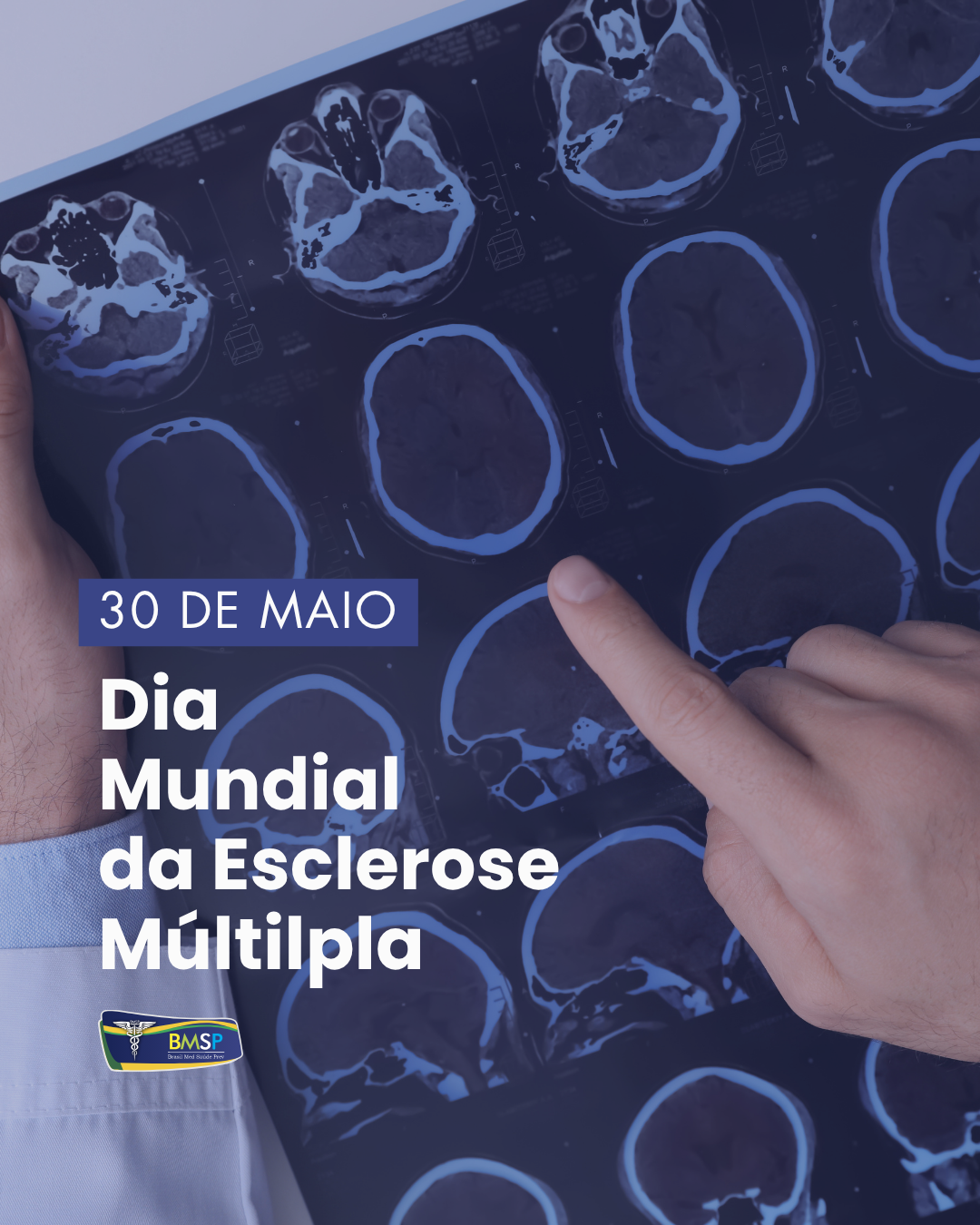 Dia Mundial da Esclerose Múltipla | Blog | BMSP - Brasil Medicina Saúde Preventiva